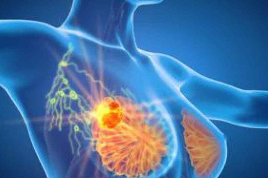 Cancro seno avanzato, cambia pratica clinica nella lotta a metastasi ...